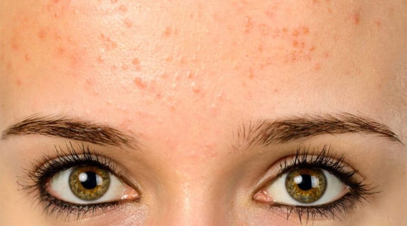 Gut Health and Skin Conditions: The Connection
